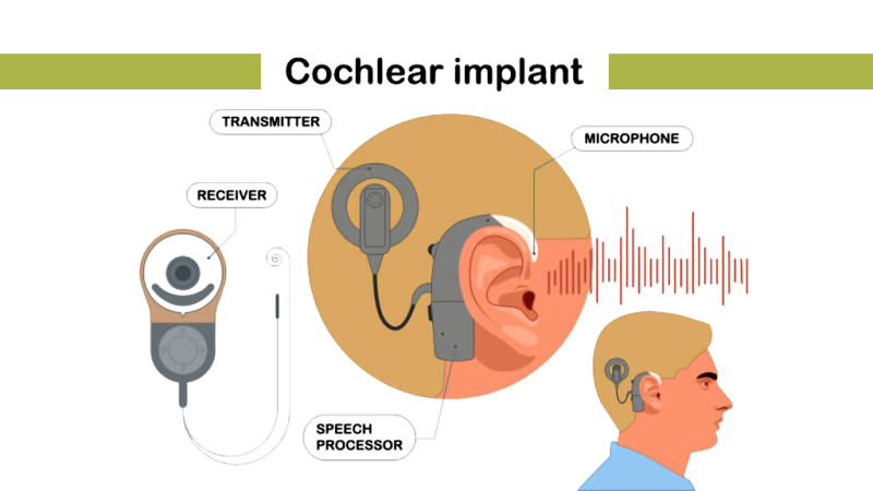 How Teletherapy is Improving Outcomes for Children with Cochlear Implants